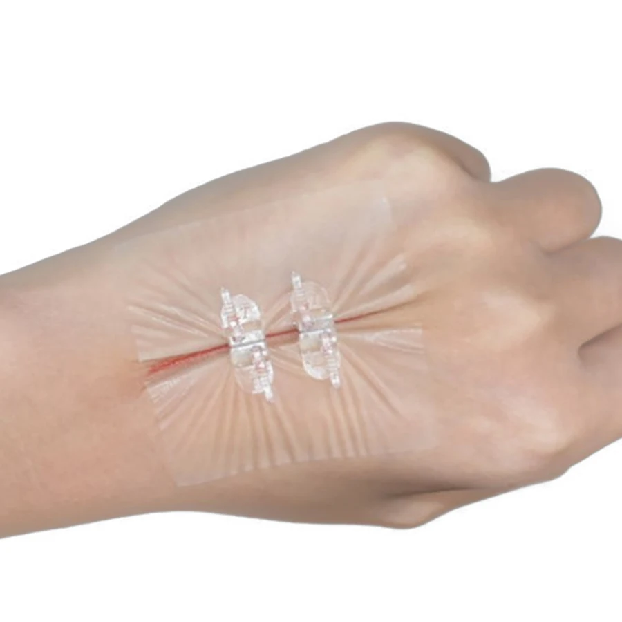 Disposable Zipstitch Zip Non-invasive Wound Closure Device Without ...