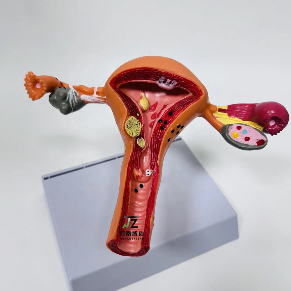 Pathological Model of Ovarian Uterus - Reproductive Medicine Gifts