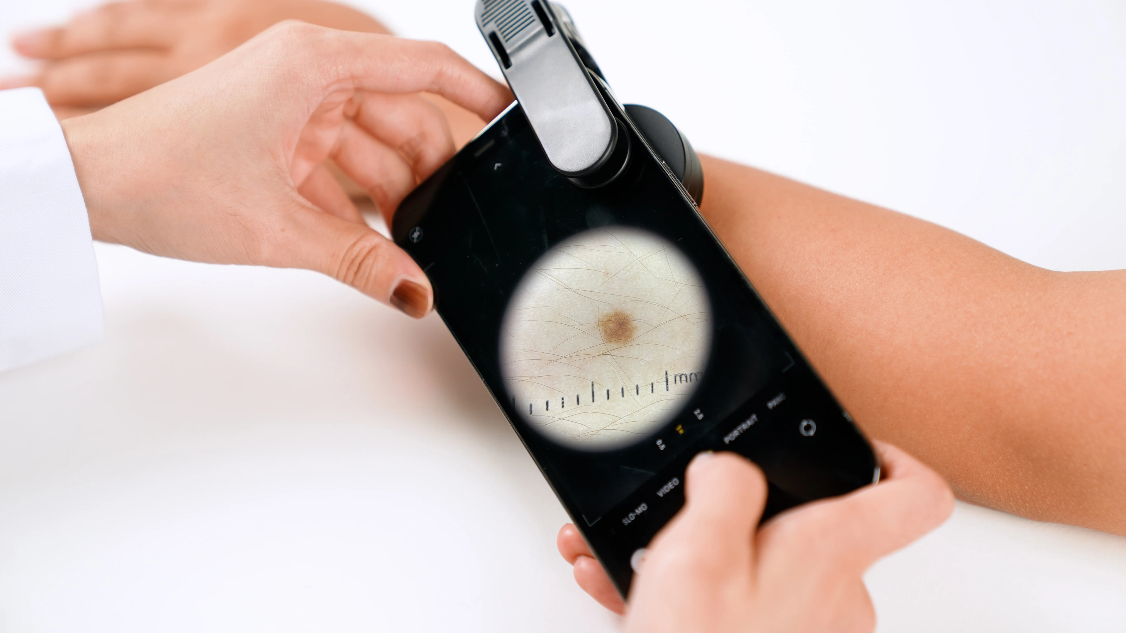 IBOOLO Electronic Dermatoscope DE-300 - Mobile Dermoscopy