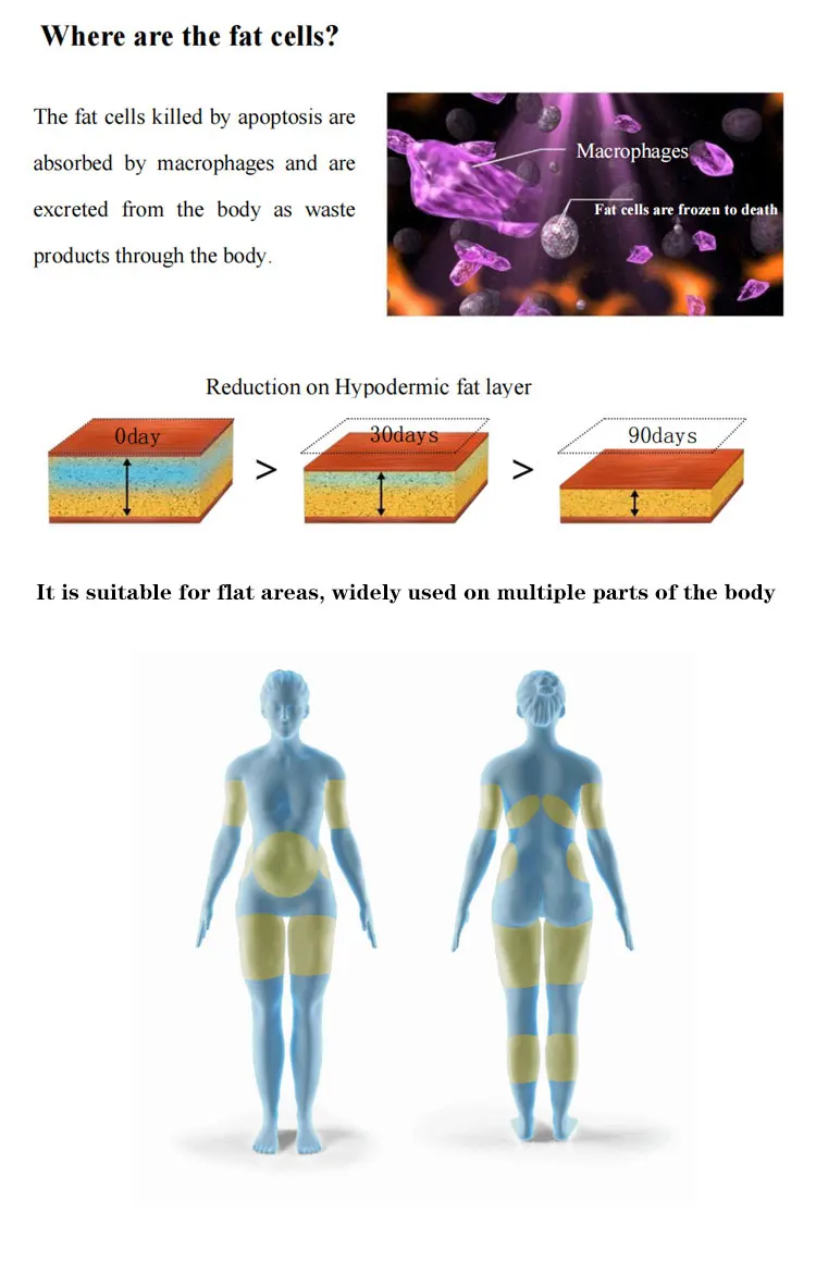 360 Cryo Non-invasive Cold Fat Freezing Fat Freeze Cryo Plates Abodmen ...