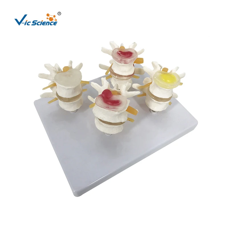 Lumbar Spine Comparison Model Human Skeleton Intervertebral Disc Four ...