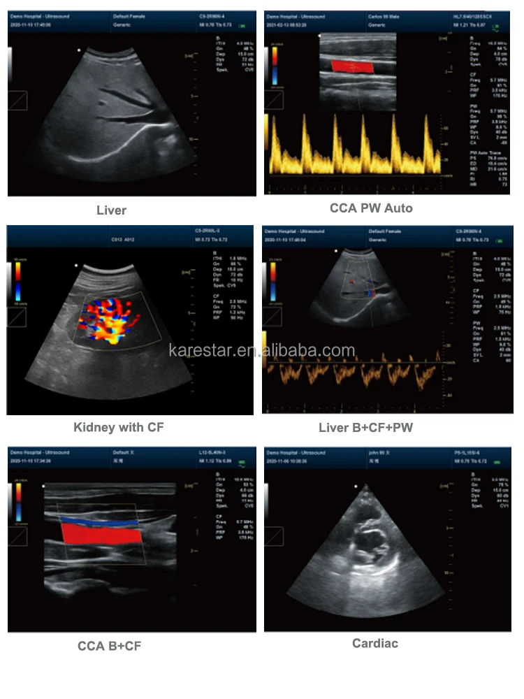 Portable Medical 3d 4d Echocardiography Ultrasound Machine Color ...