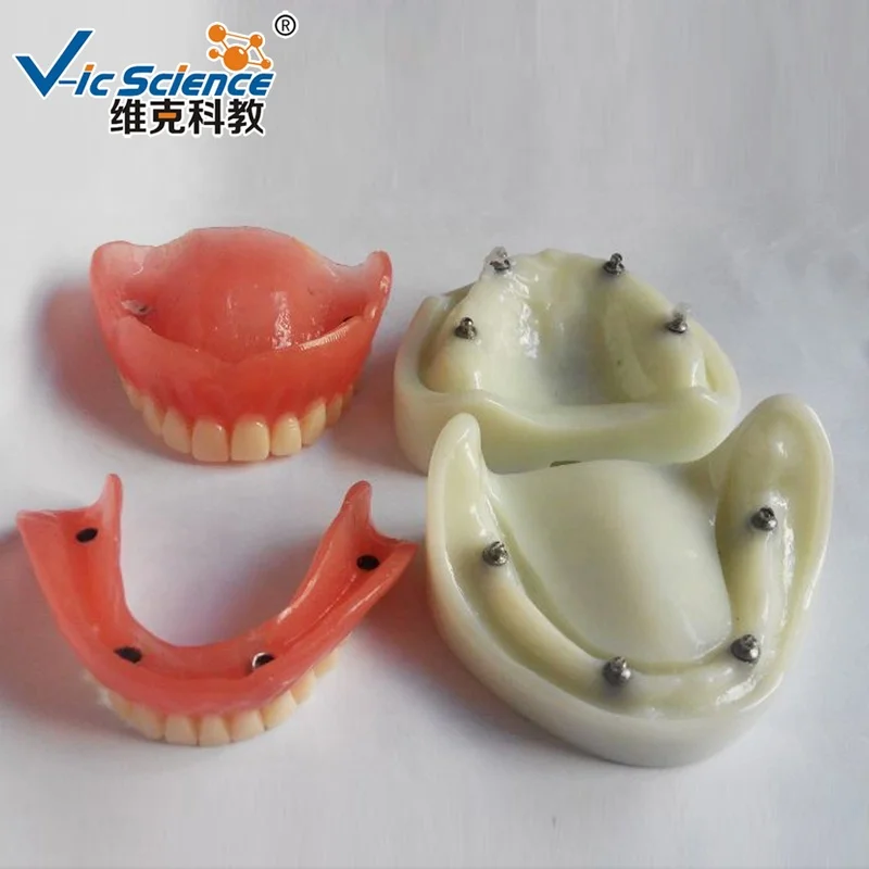Full Denture Implant Model for Medical Science Education