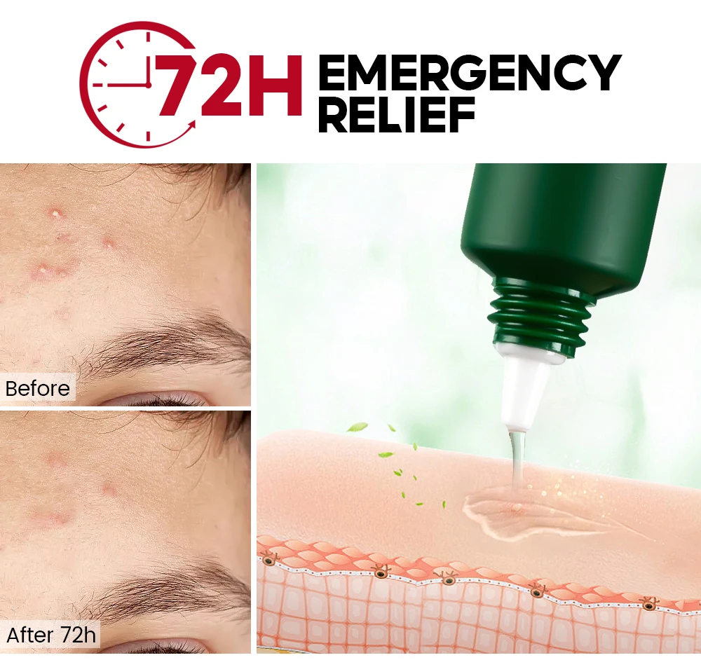 Natural Organic Herbal Extract Ointment For Stretch Marks Black Spots ...