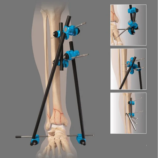 Large Bone Temporary External Fixation System 5mm 8mm 11mm 12mm Carbon ...