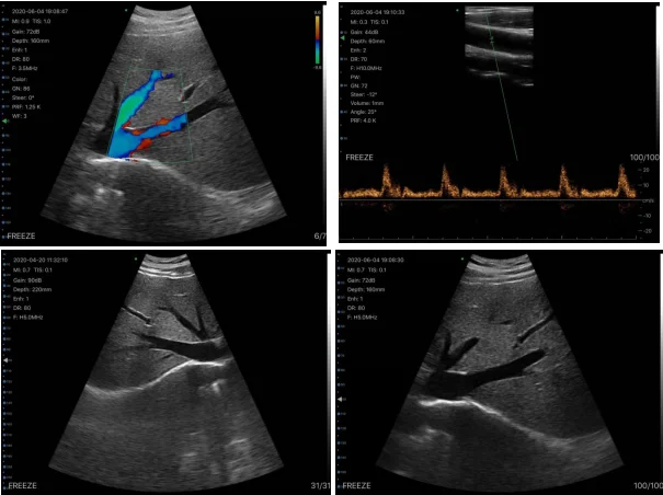 MSLPU80 Wireless Color Doppler Ultrasound Scanner - Double Probes