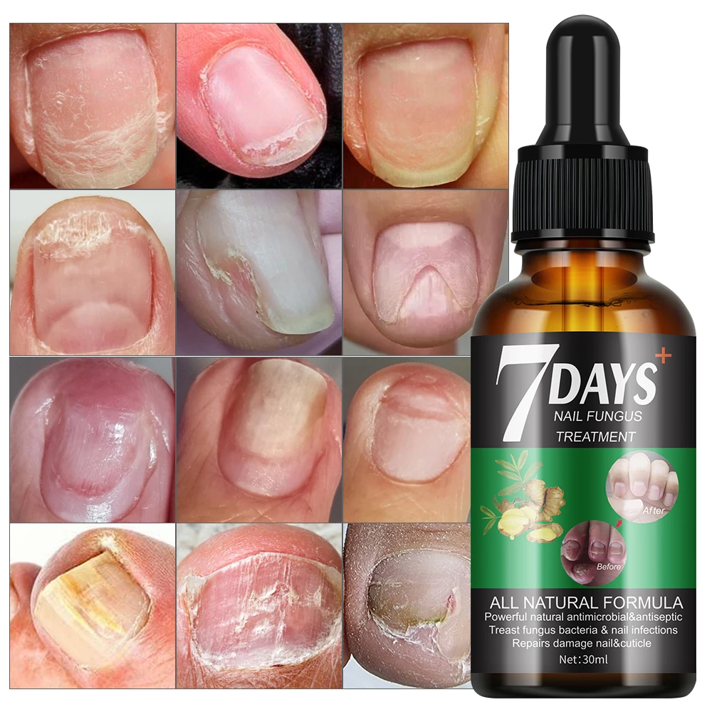 7 Days Nail Fungus Treatment Serum Repairs Damage Nail & Cuticle Treast Fungus 30ml MOOYAM Nail ...