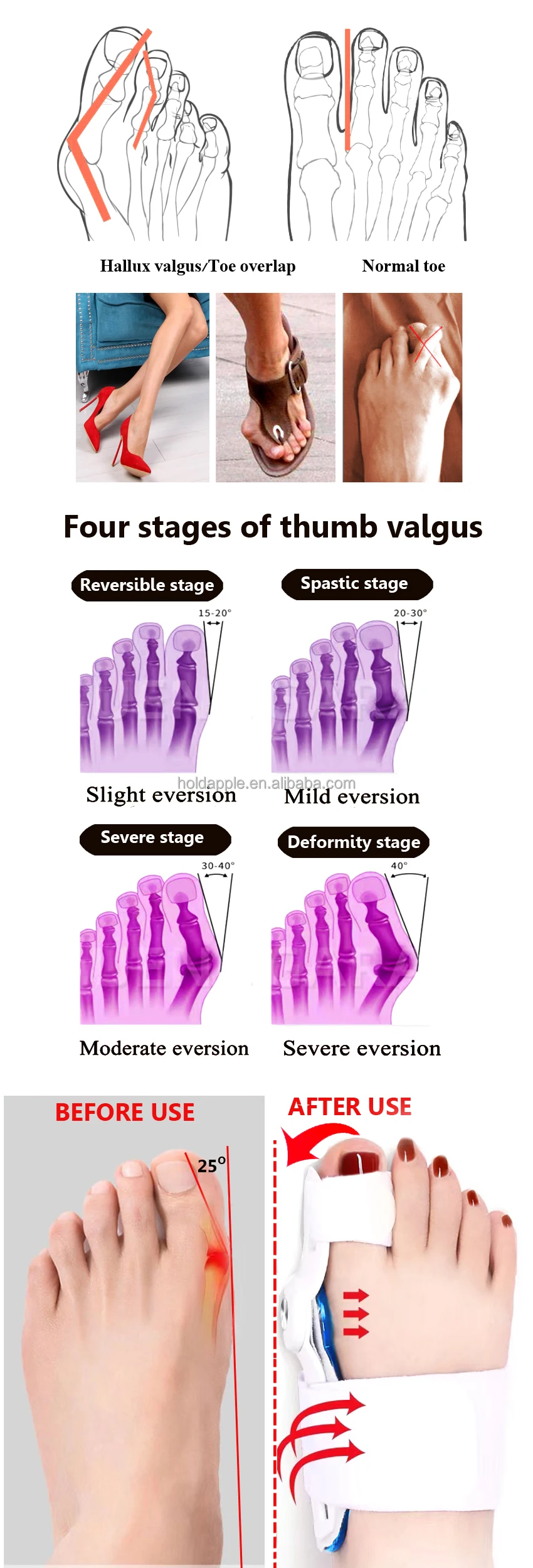 Medical Bunion Night Splint - Valgus Pro Hallux Valgus