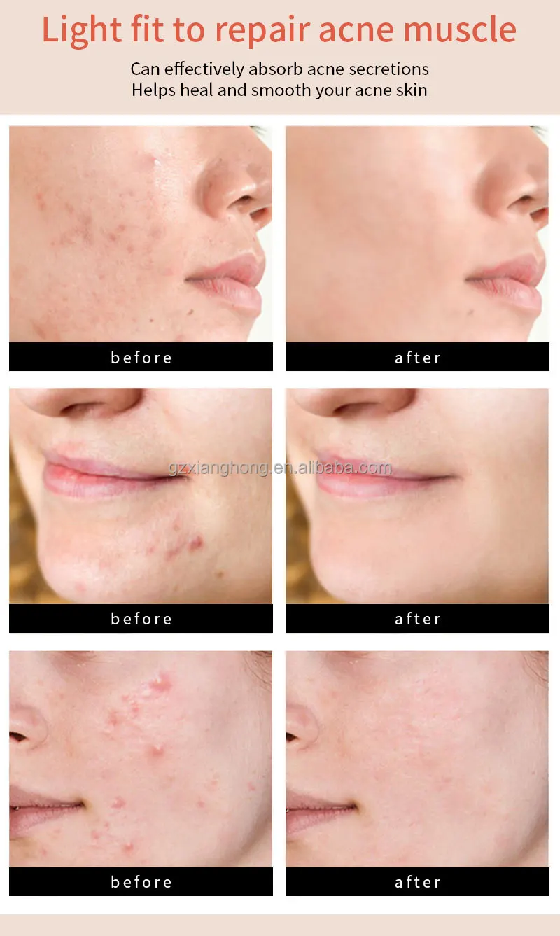 36pcs Pimple Patches Customize Logo Mighty Pimple Patch Private Label ...