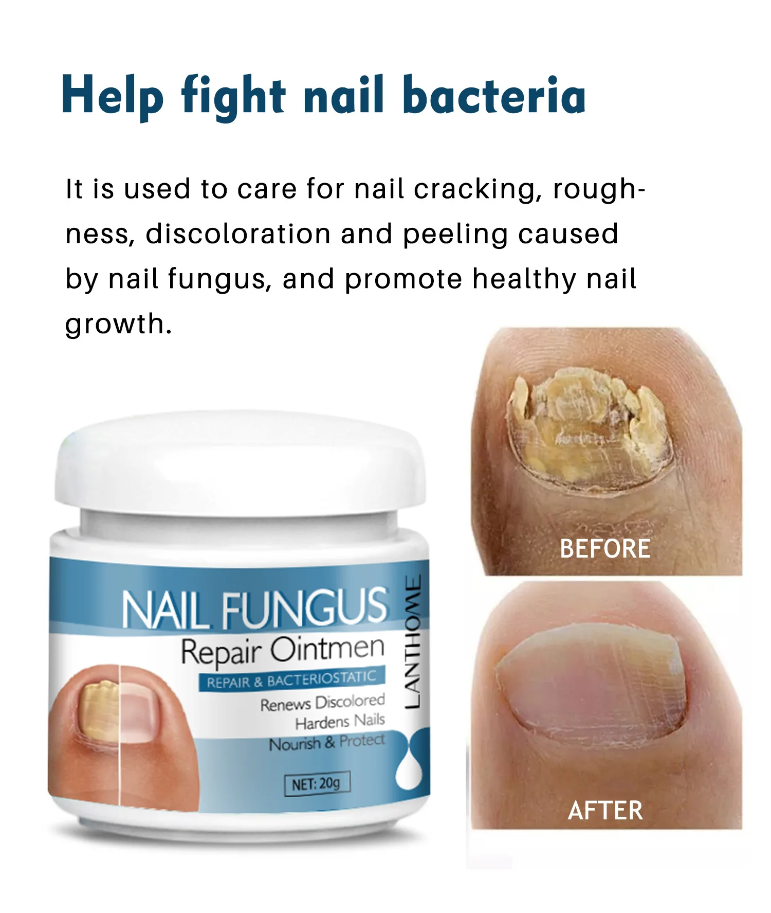 OEM Nail Fungus Repair Ointment - Antifungal Cream for Fungal Treatment ...