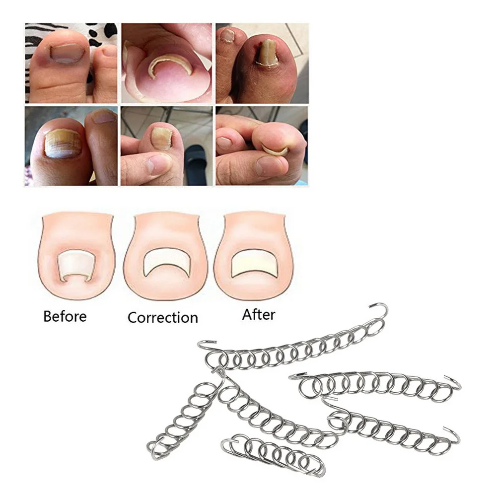 Ingrown Nail Correction Kit Ingrown Toenail Stickers Toe Nail Clamp ...