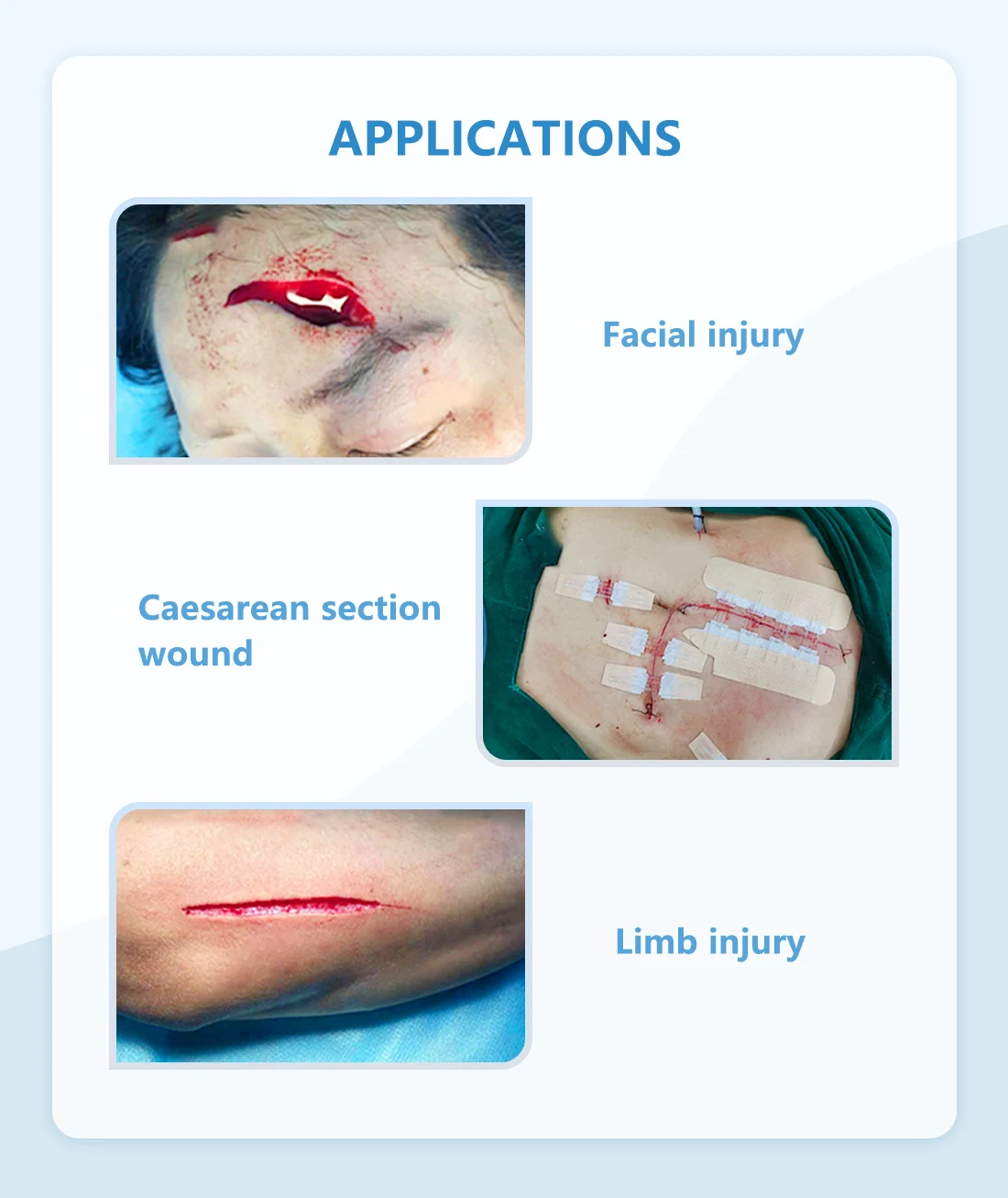 BLUENJOY Sterile Skin Color Wound Closure Device - Zip Stitch Wound Care