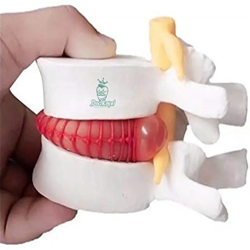 Lumbar Vertebrae with Herniated Disk - Teaching Model