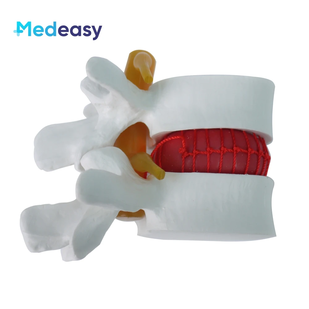 Lumbar Disc Herniation Model - Educational Anatomical Tool