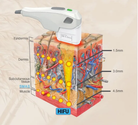 7D Hifu Machine - Advanced Skin Tightening & Face Lifting