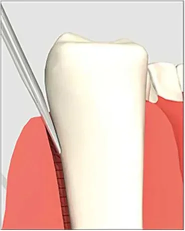 Minimally Invasive Dental Extraction with Jinguang Forceps