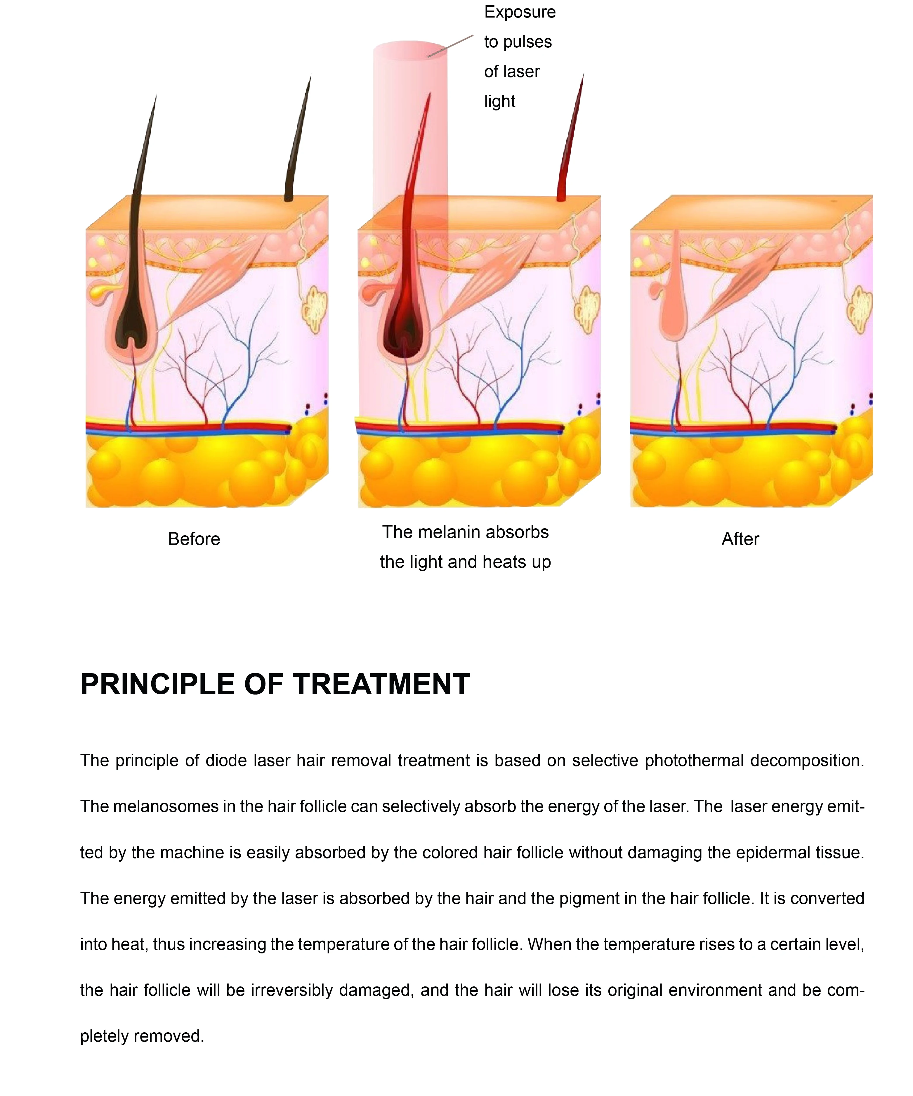 Portable Laser 4 Waves Diode Lazer Legs Hair Removal Machine| Alibaba.com