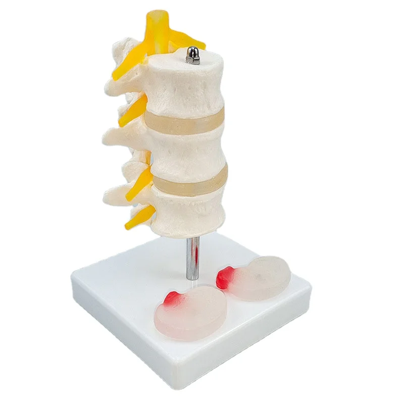 Lumbar Vertebra Model For Medical Science Pathological Model Of Lumbar ...