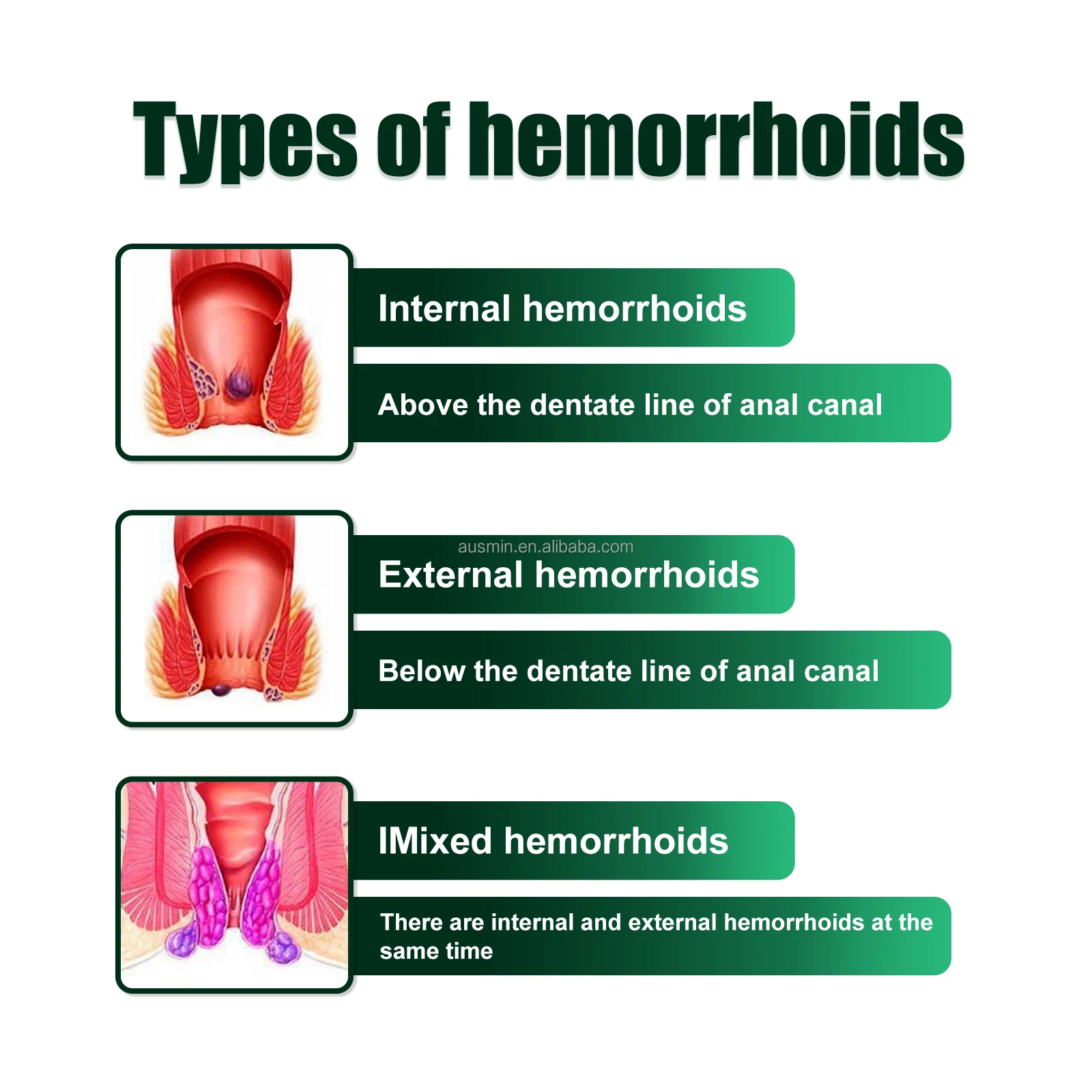 Wholesale Plant Herbal Hemorrhoid Ointment Relieve Pain Anal Bleeding ...