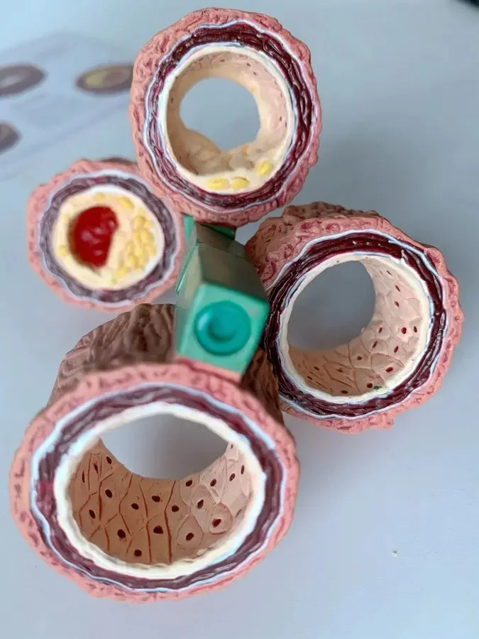 Human Artery Atherosclerosis Model - Anatomical Vascular Disease ...