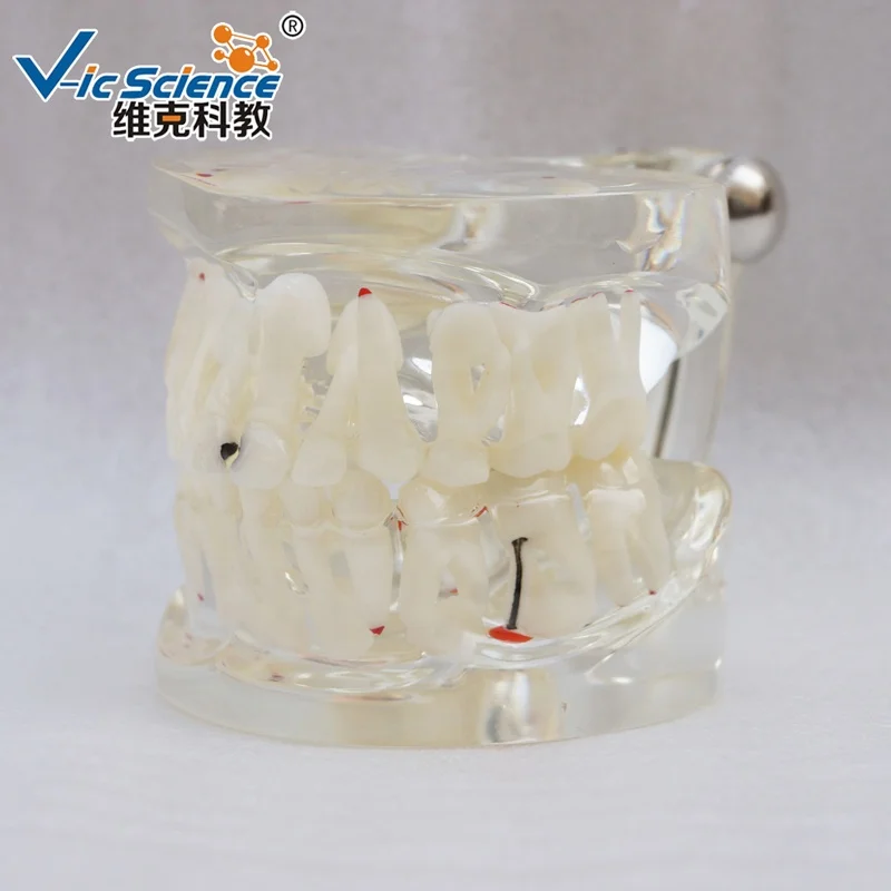 Anatomical Model Of Deciduous Permanent Teeth With Alternating Caries ...