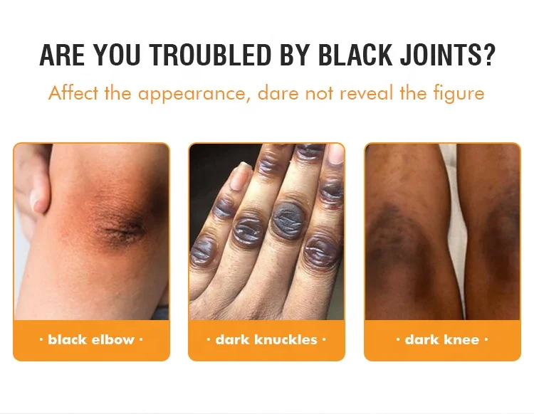 Instant Strong Whitening Cream Lotion for Dark Knees & Elbows ...