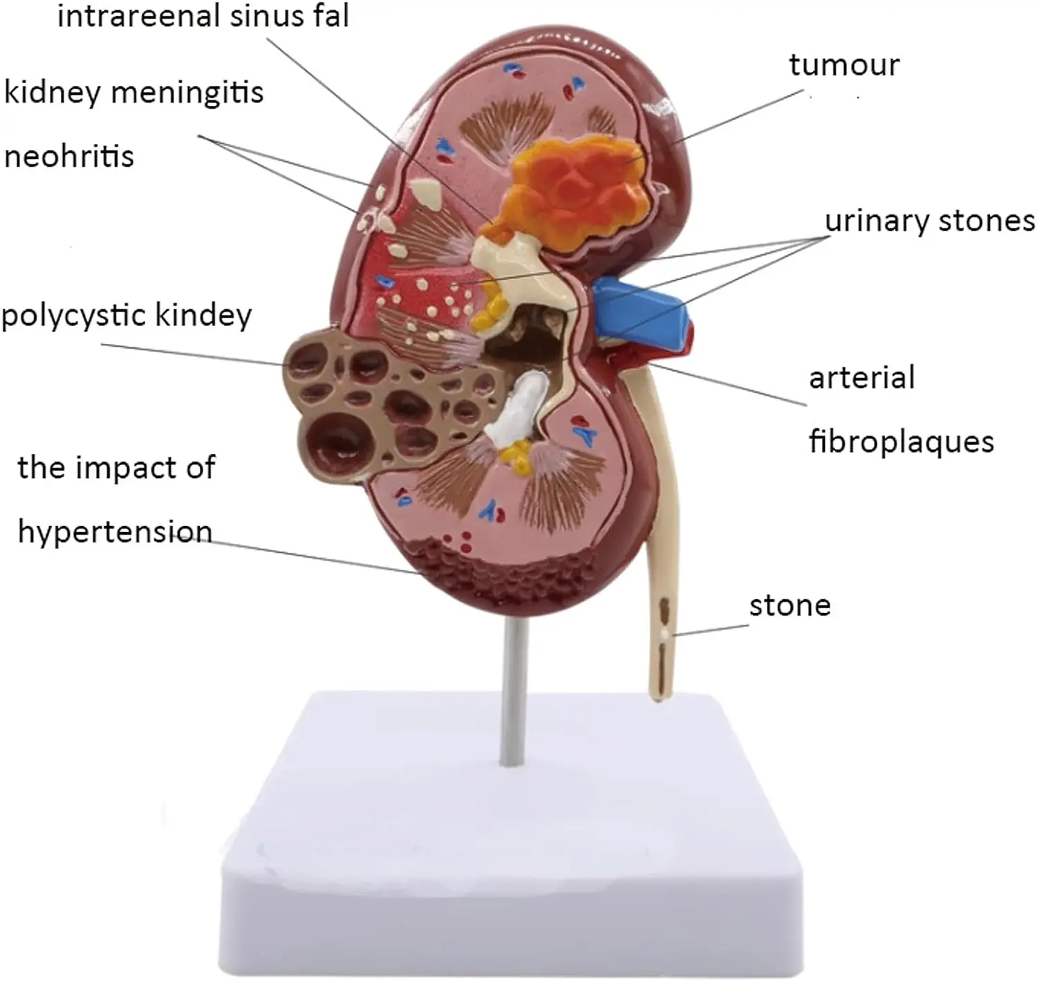 Pathology Kidney Model - Dual Perspective for Education