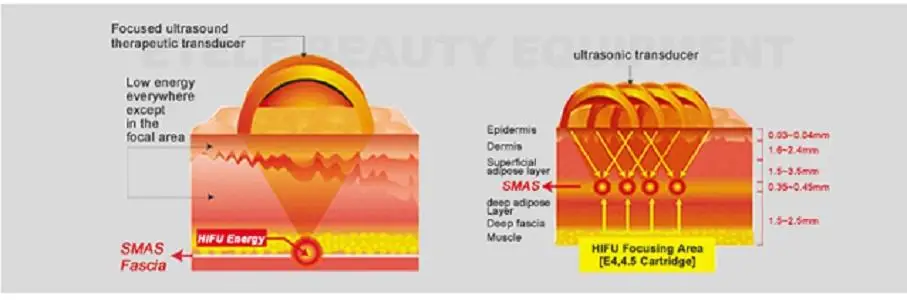 1:1 Logo Classic Hifu Machine With 3 Cartridges Factory Price 2d Hifu ...