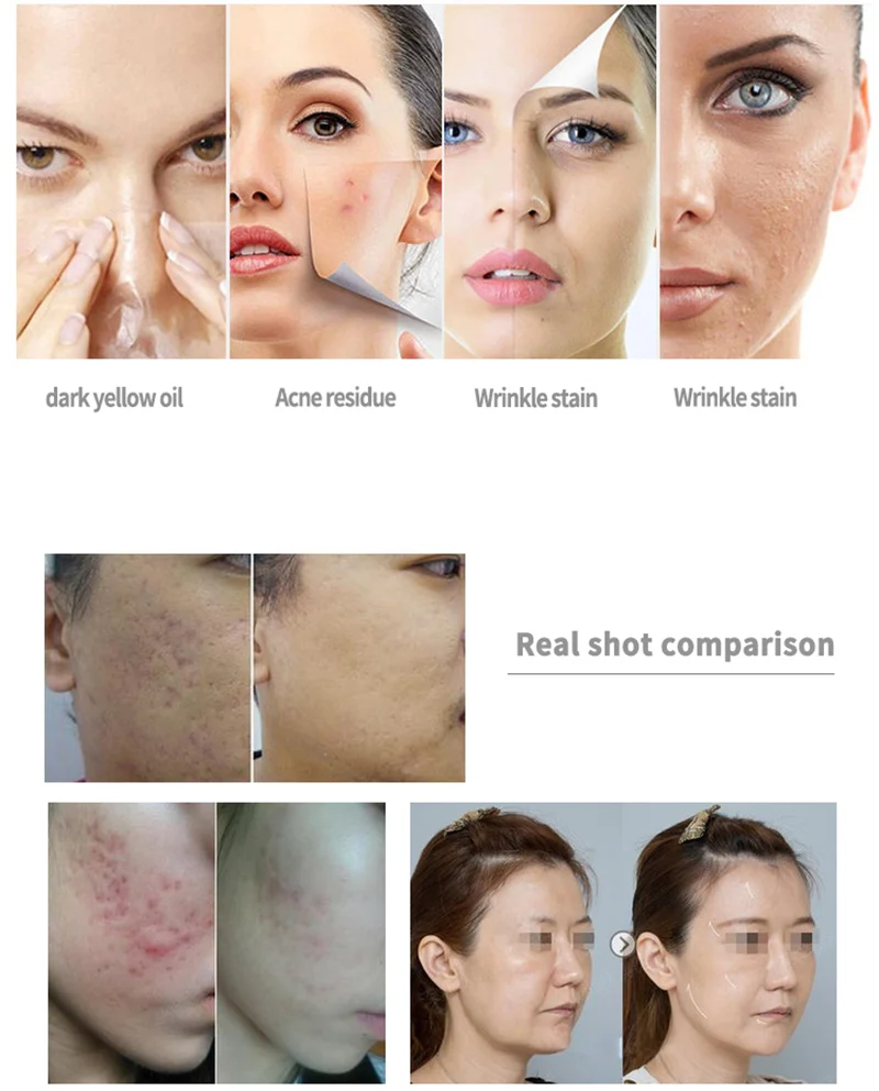 3 In 1 Oxygen Facial Rf Meso Machine With Ultrasound Water Oxyfusion ...