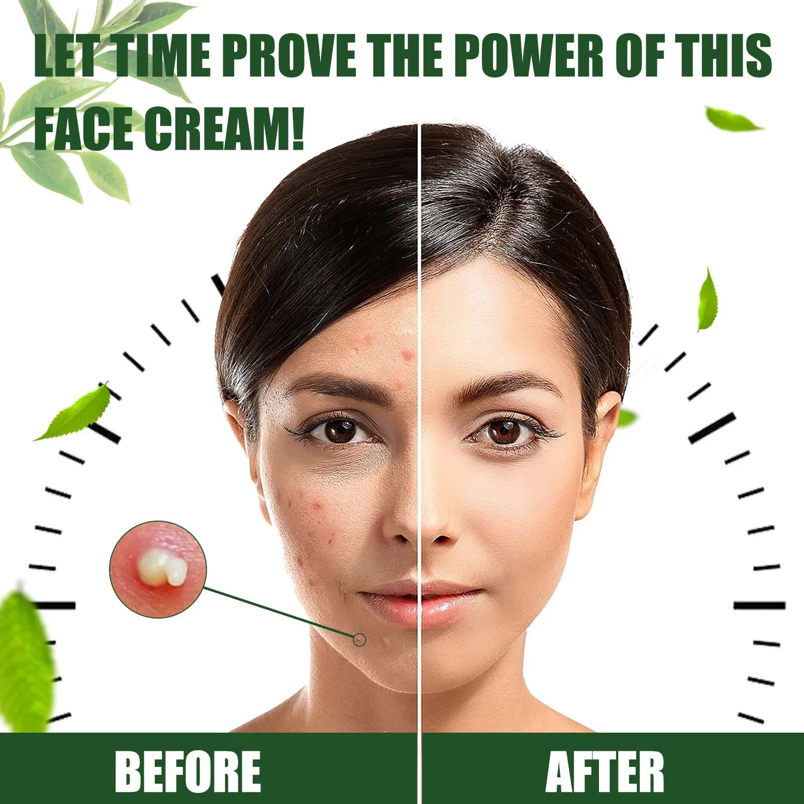 Acne Cream Pimple Treatment Cream Hydrating Control Oil Quickly Remove Pimples For Men And Women