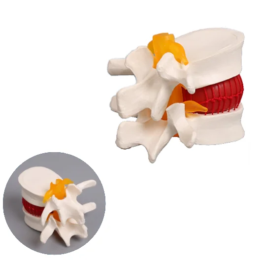Human lumbar disc Herniation Demonstration anatomy model teaching model ...