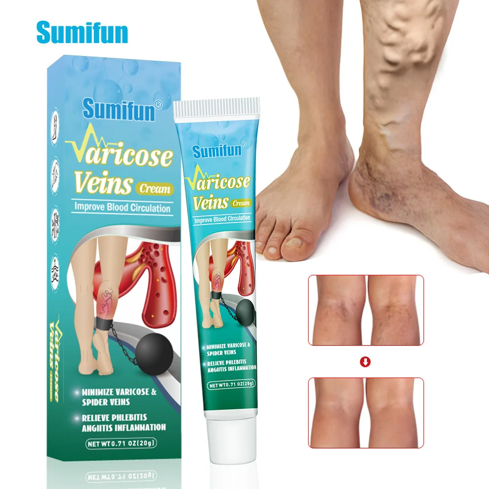 Varicose Veins Cream Relief Veins Pain Phlebitis Angiitis Herbal Cream ...