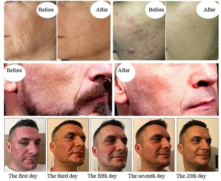 Tixel Machine for Collagen Regeneration and Skin Renewal