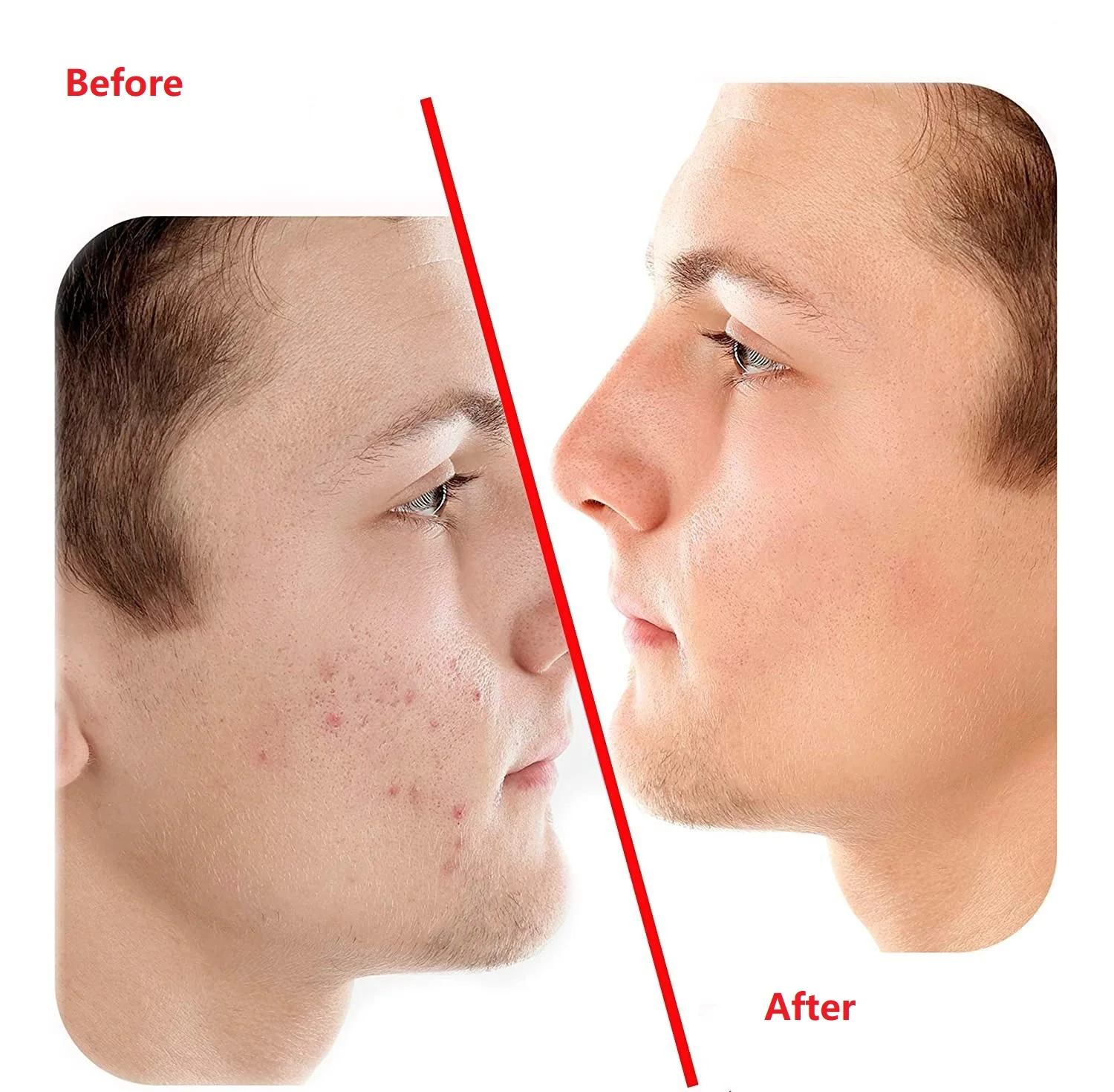 Oem Hydrocolloid Weed Pimple Acne Patch Oem Private Label Korean Care ...