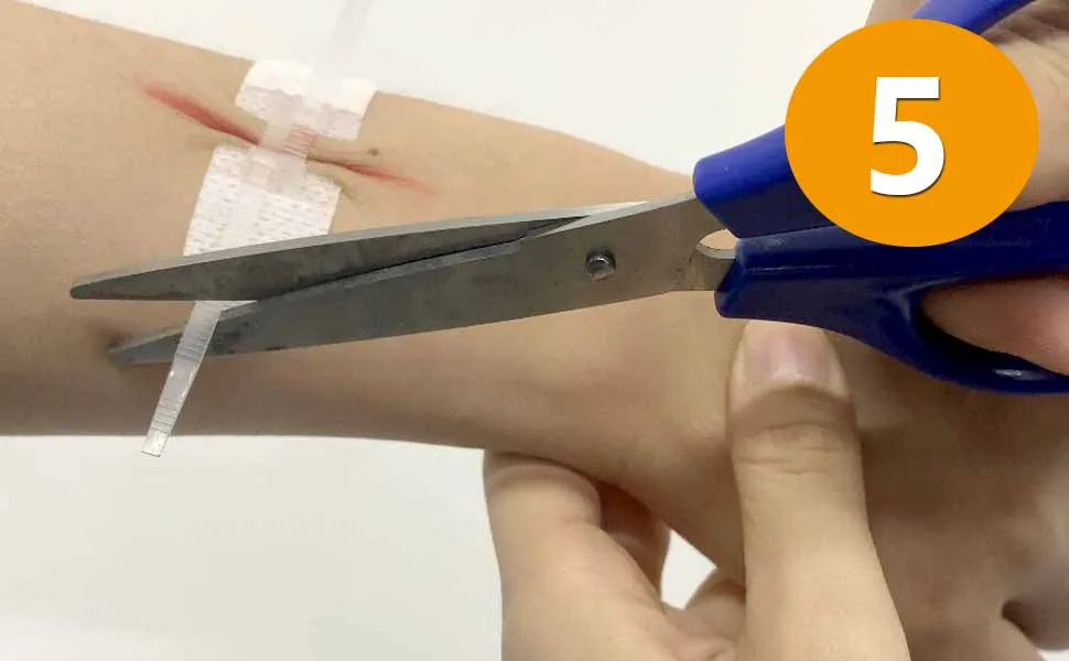 Surgical Zip-Stitch Sutures - Efficient Wound Closure