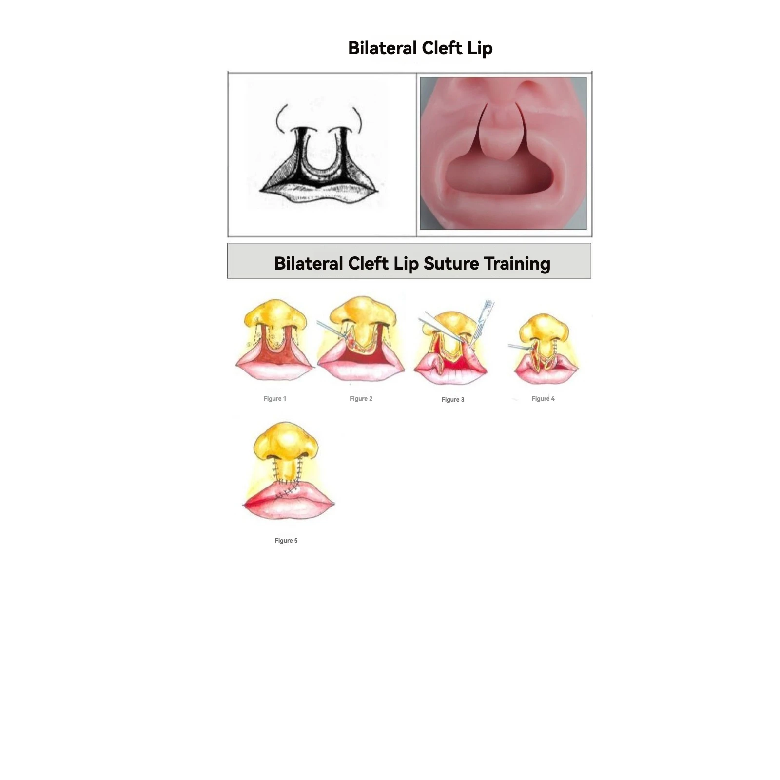 KyrenMed Lip Fissure Closure Surgery Training Model Silicone Harelip ...