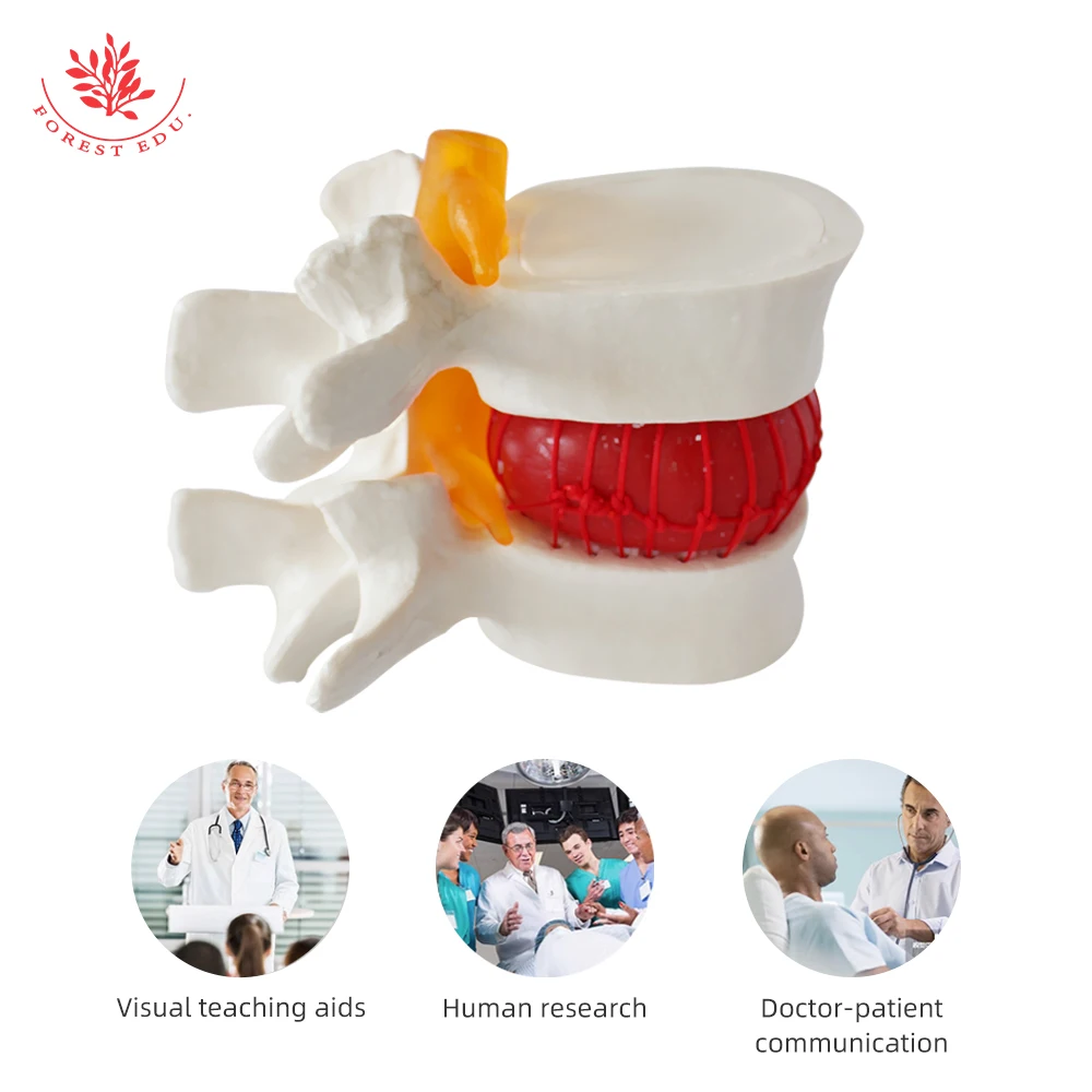 Human Lumbar Disc Herniation Spine Model FRT039 Pathology ...