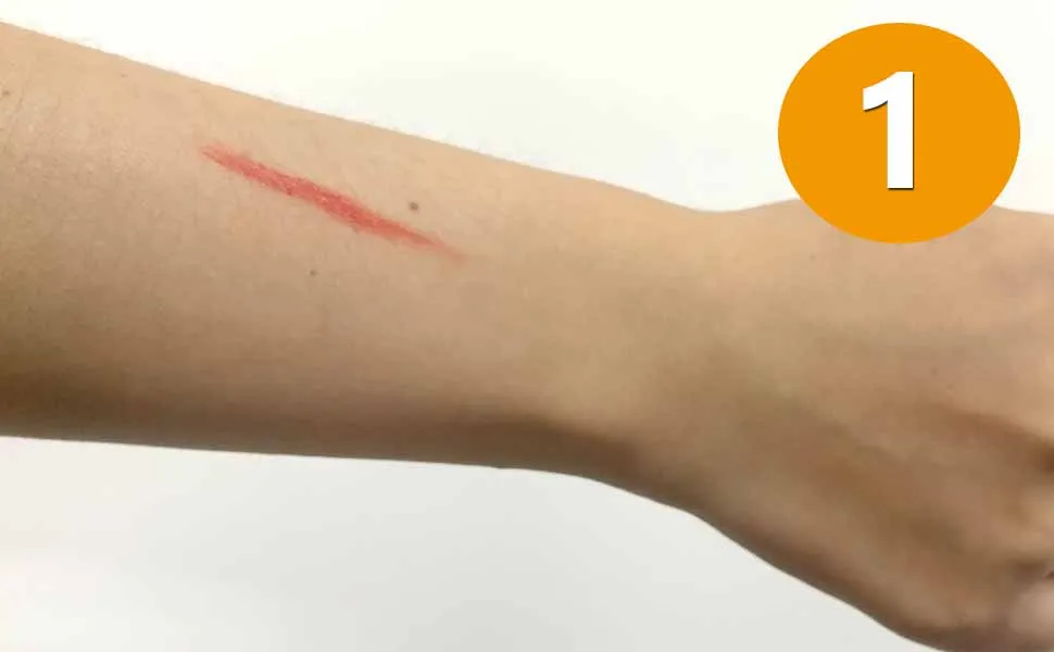 Surgical Zip-Stitch Sutures - Efficient Wound Closure