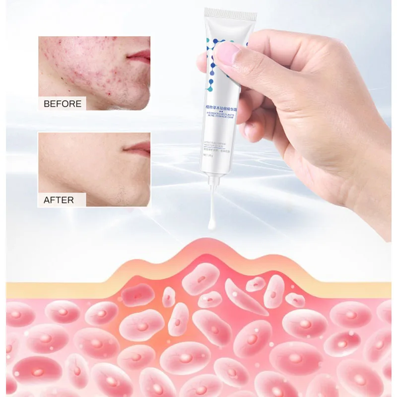 Herbal Acne Removal Face Cream Anti-acne Gel Treatment Acne Scar Oil ...