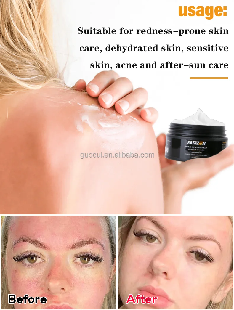 Fatazen After Sun Acne Repairing Cream For Redness Pone Anti Aging ...