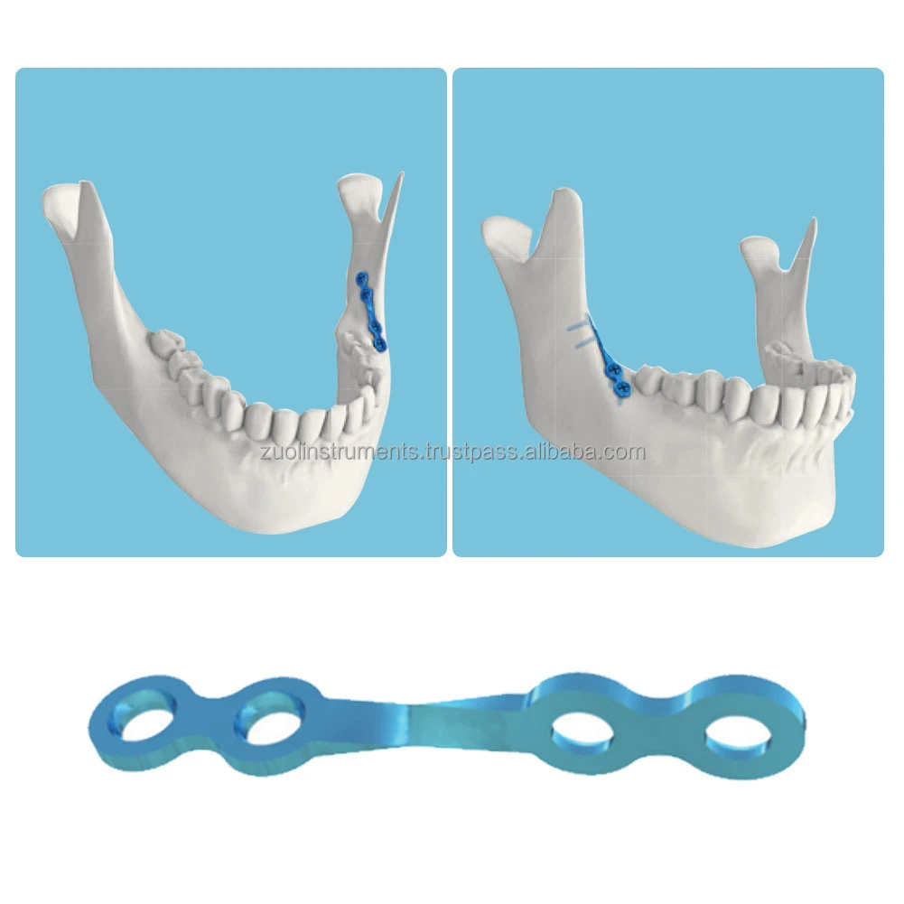 Anatomical 2d Round Hole Metal Maxillofacial Plate Neurosurgery Cranial ...