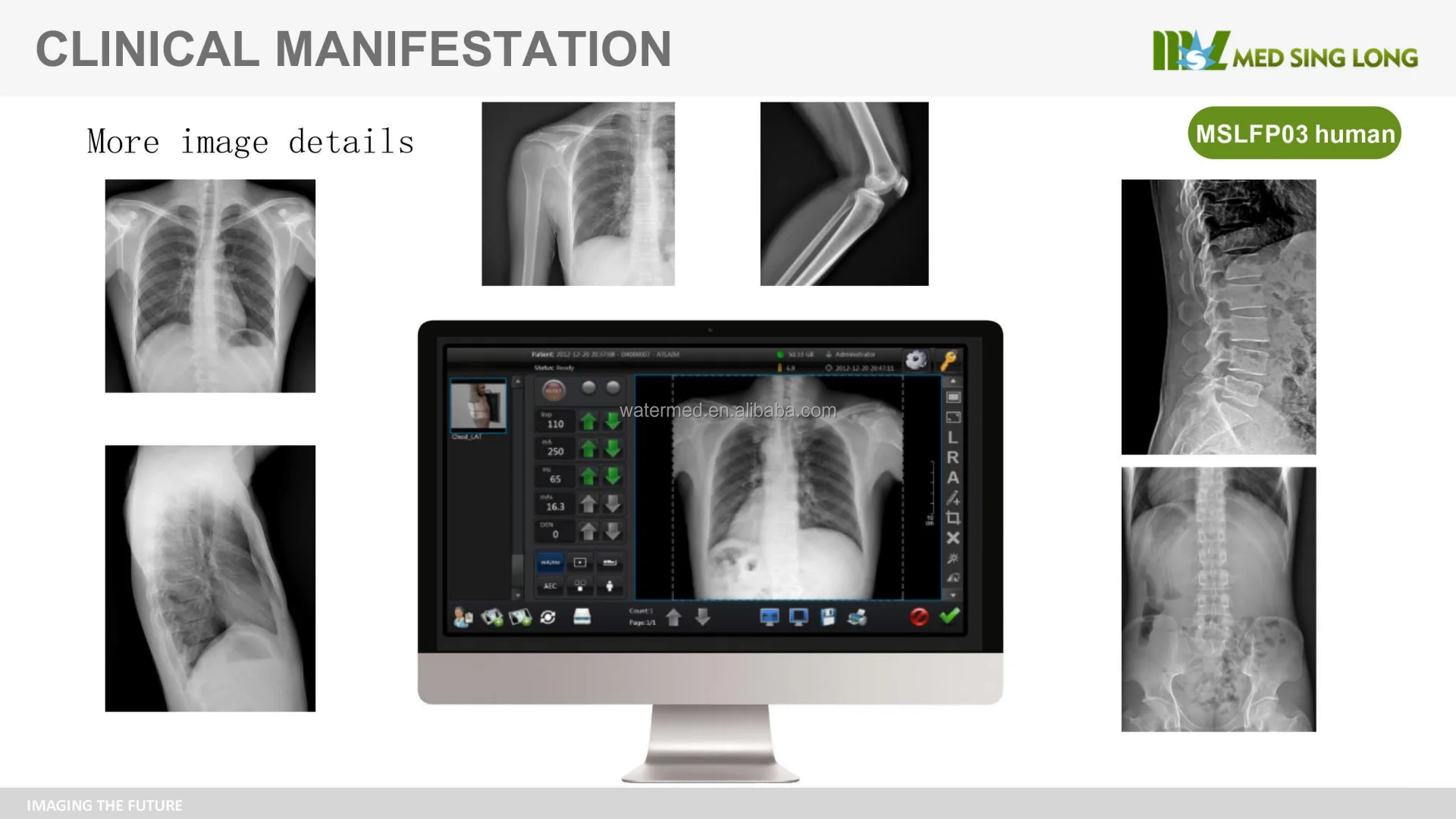Iray Medical FPD DR Wireless Flat Panel Detector - 5KW X-ray