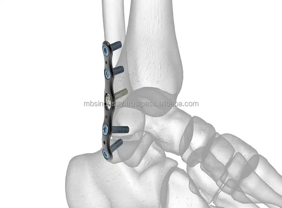 Titanium Implants Plates For Orthopedic In Food Grade And Best For ...