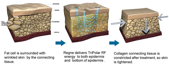 Korean TRIGEN Portable Home Use Tripolar Skin Lifting Machine